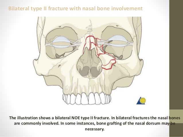 NOE fractures