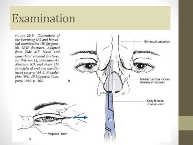 NOE fractures