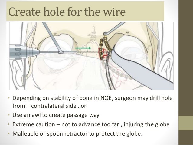NOE fractures
