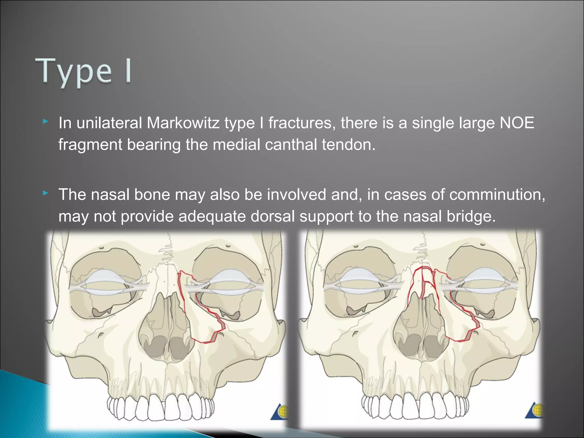 NASO-ORBITO-ETHMOIDAL fracture and management | PPT