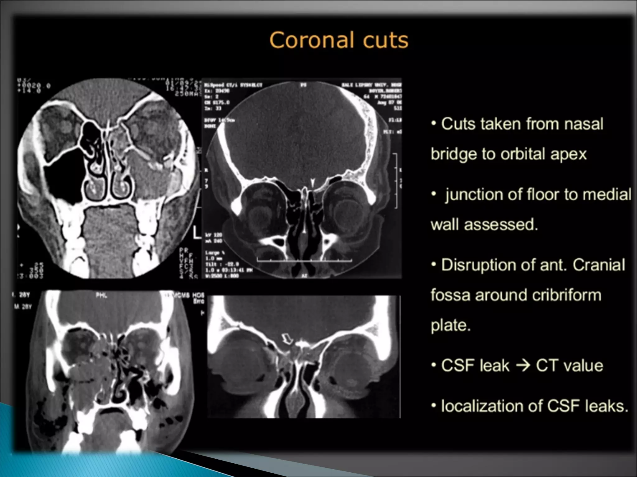 NASO-ORBITO-ETHMOIDAL fracture and management | PPT