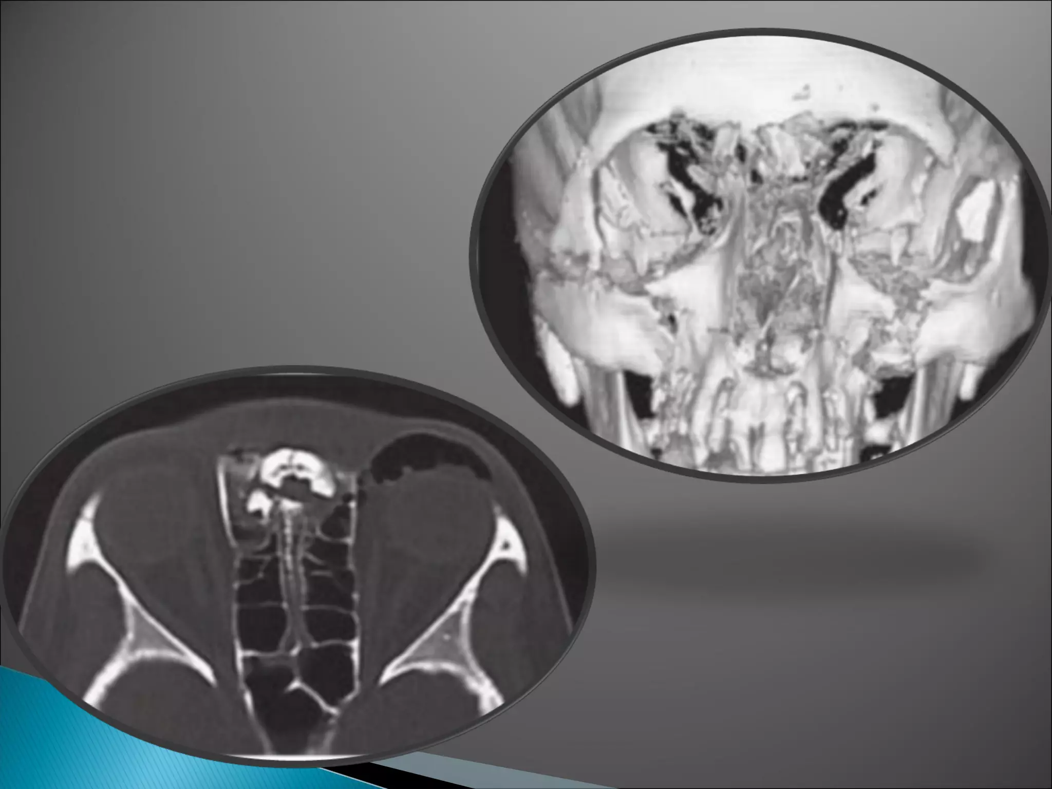 NASO-ORBITO-ETHMOIDAL fracture and management | PPT