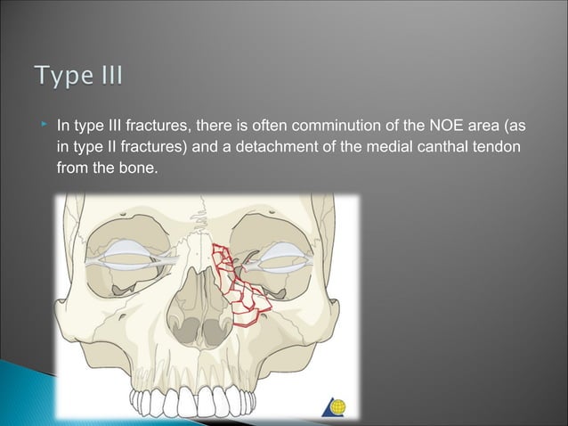 NASO-ORBITO-ETHMOIDAL fracture and management | PPT | Death, Injury, or ...