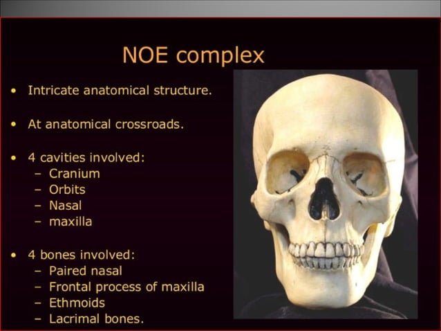 NASO-ORBITO-ETHMOIDAL fracture and management | PPT | Death, Injury, or ...