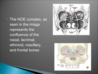 NASO-ORBITO-ETHMOIDAL fracture and management | PPT