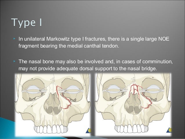 NASO-ORBITO-ETHMOIDAL fracture and management