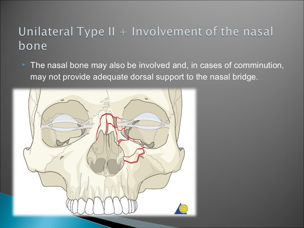 NASO-ORBITO-ETHMOIDAL fracture and management