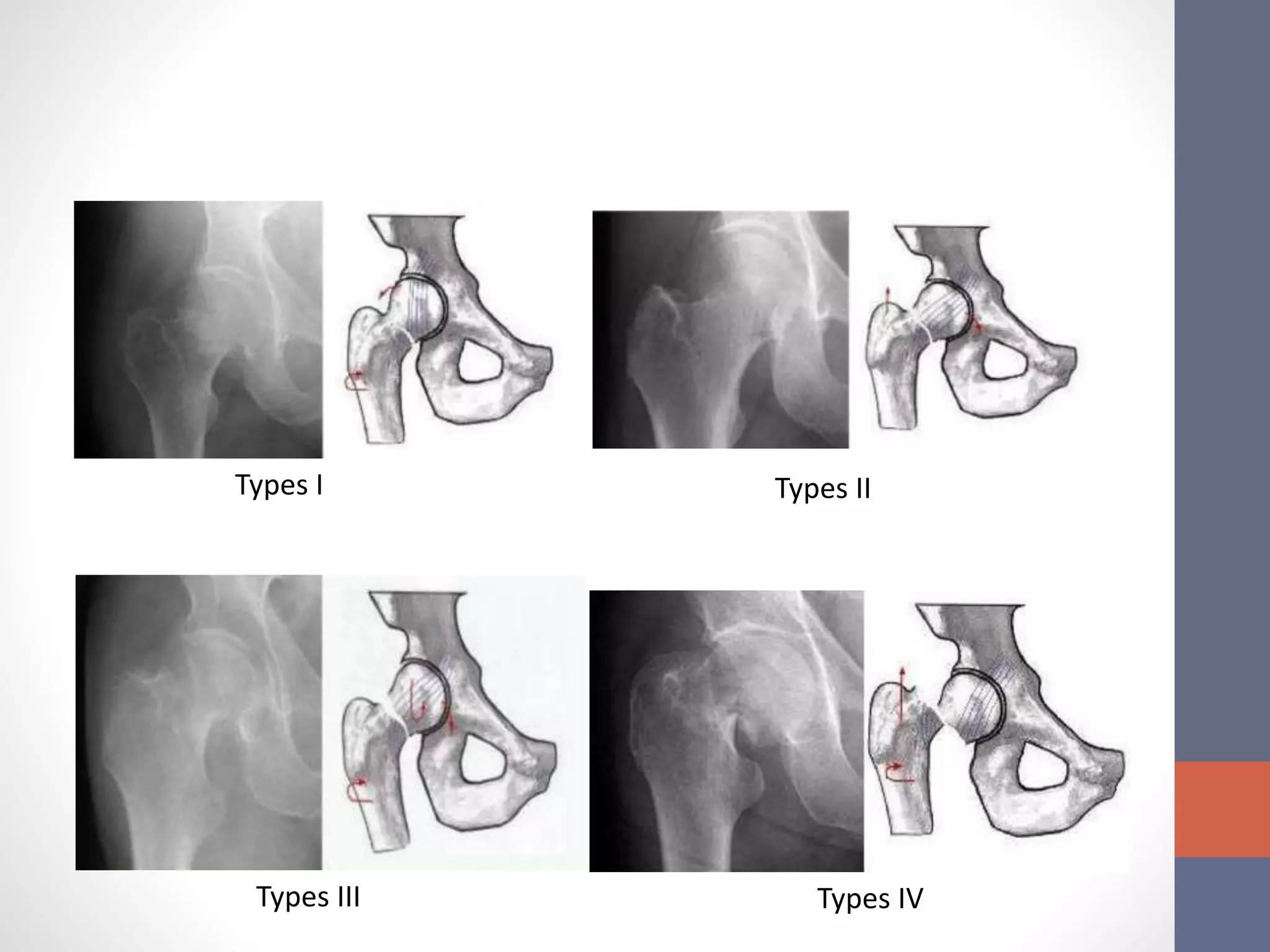 neck of femur fracture | PPTX