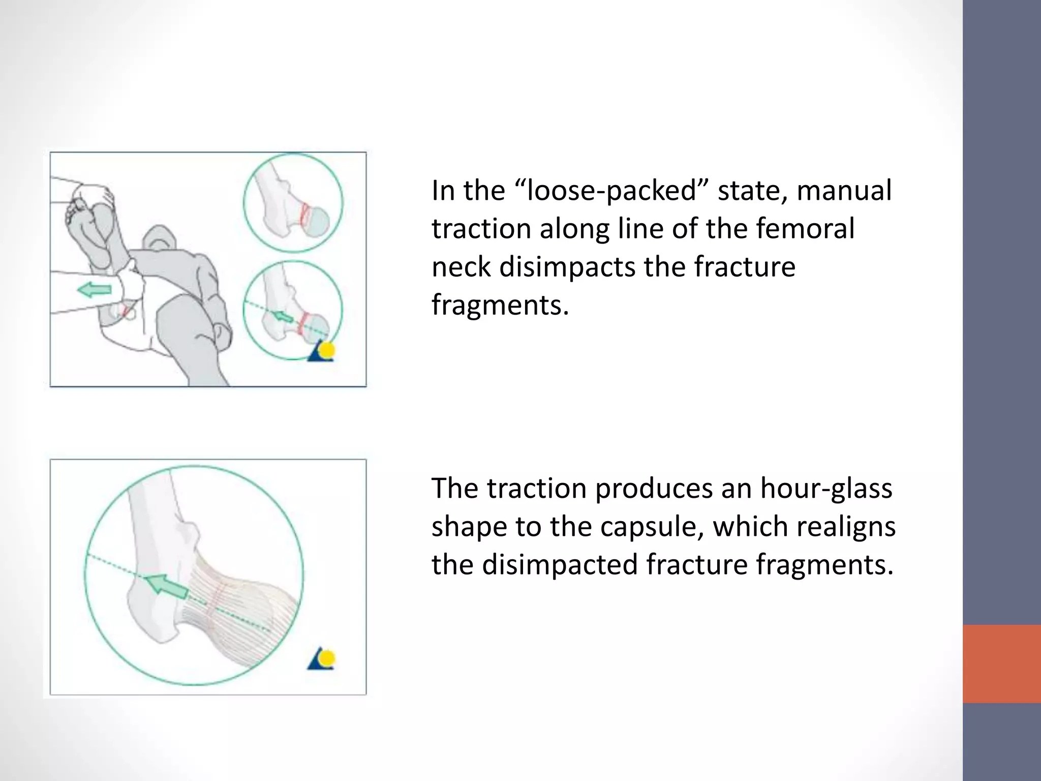 neck of femur fracture | PPTX