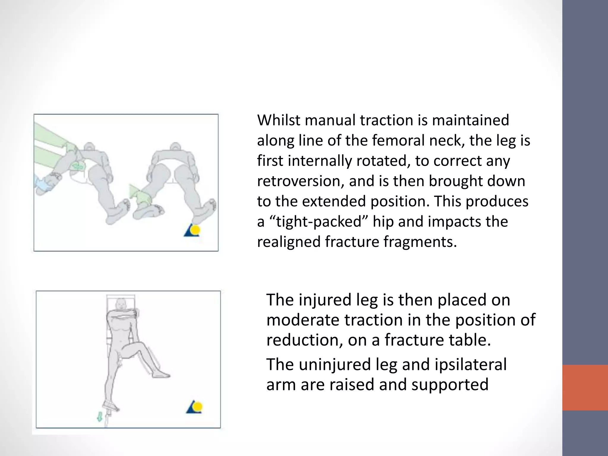 neck of femur fracture | PPTX
