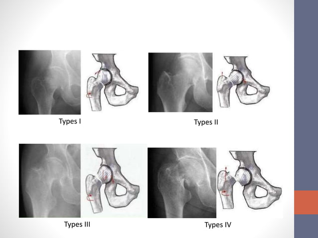 neck of femur fracture | PPTX