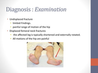 neck of femur fracture | PPT