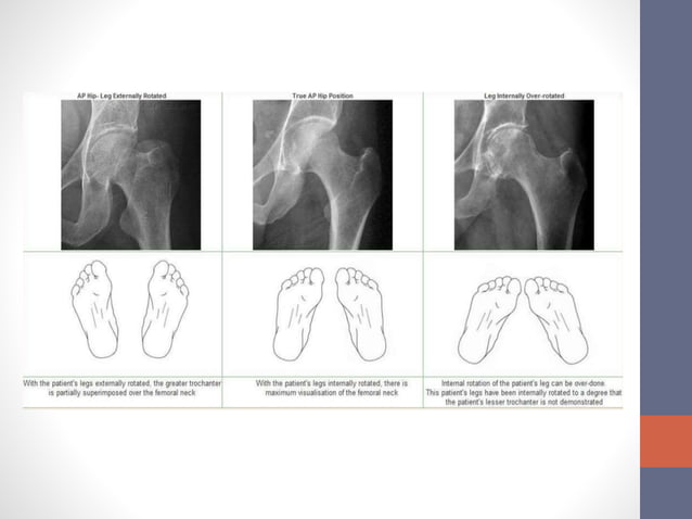 neck of femur fracture | PPTX