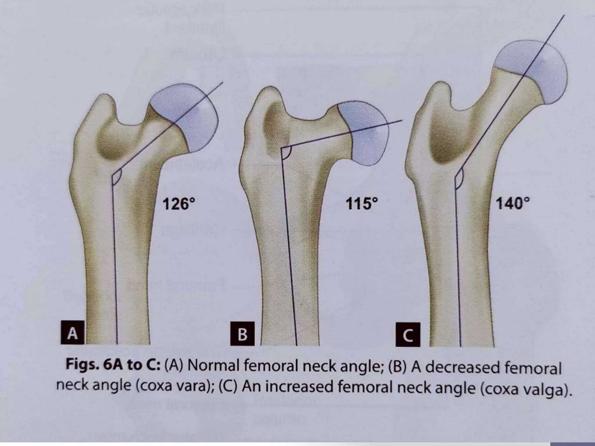 Fracture Neck Of Femur | PPTX