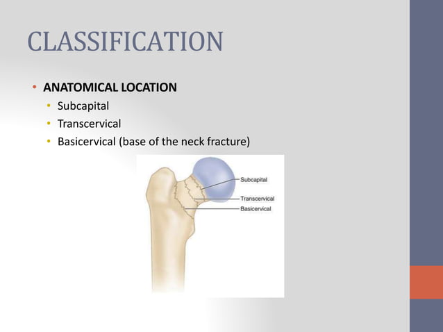 Fracture Neck Of Femur | PPTX