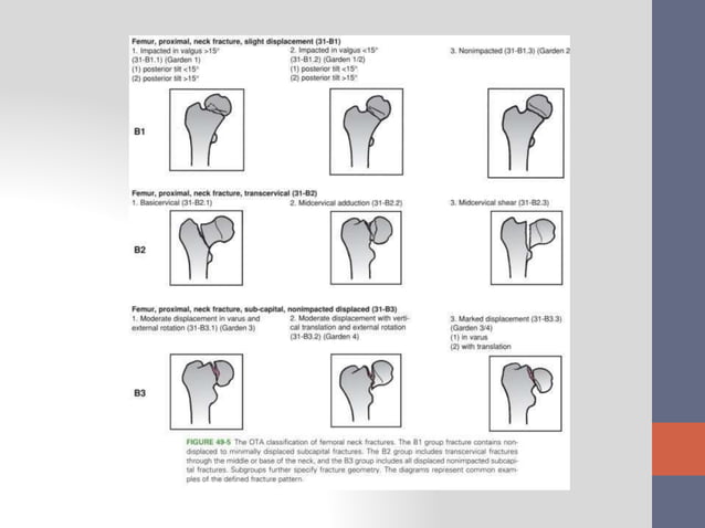 Fracture Neck Of Femur | PPTX