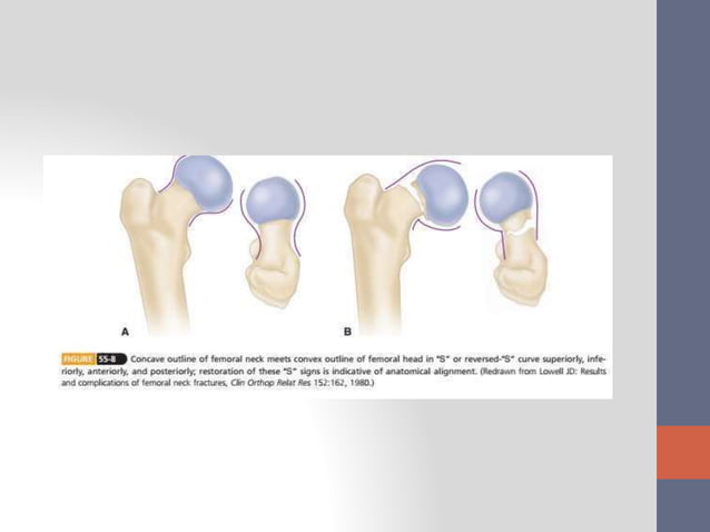Fracture Neck Of Femur | PPTX
