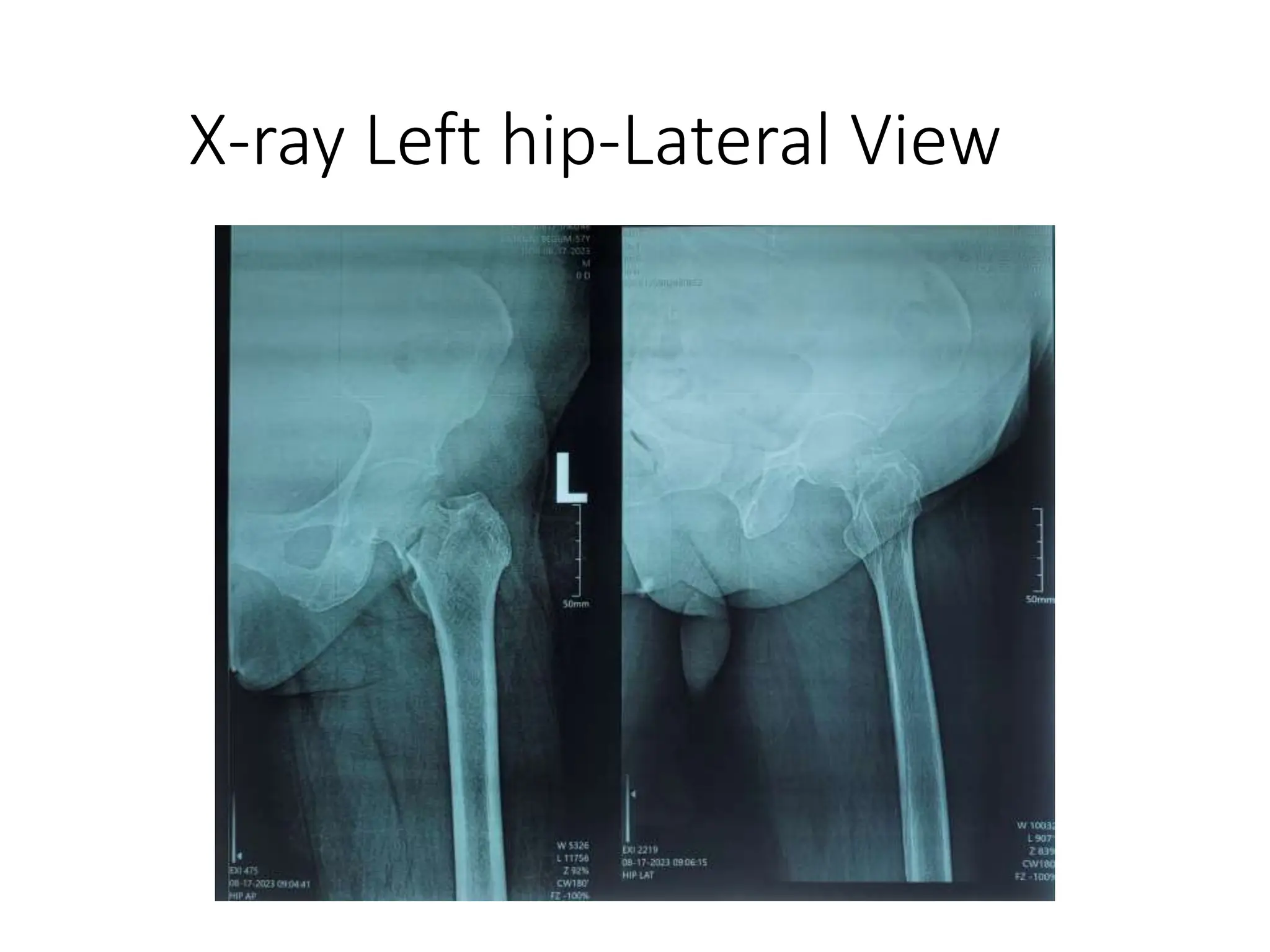 Case presentation on Fracture neck of femur | PPTX