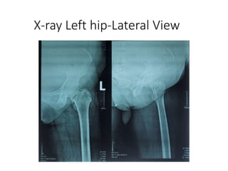 Case presentation on Fracture neck of femur | PPTX