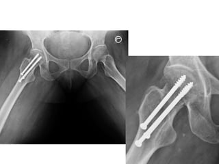 Nof fixation sequence | PPT