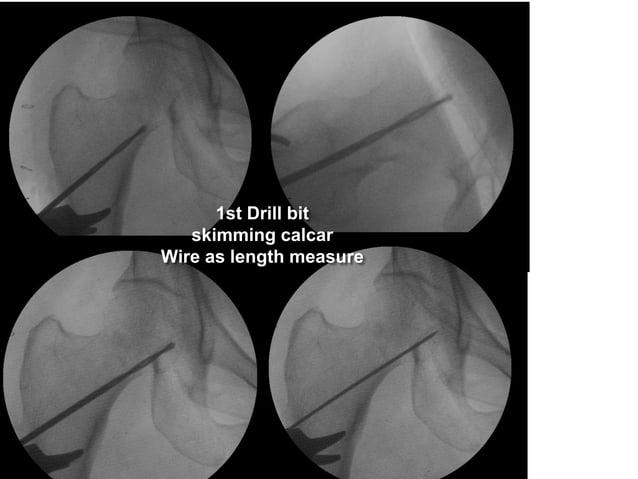 Nof fixation sequence | PPTX