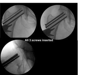 Nof fixation sequence | PPTX