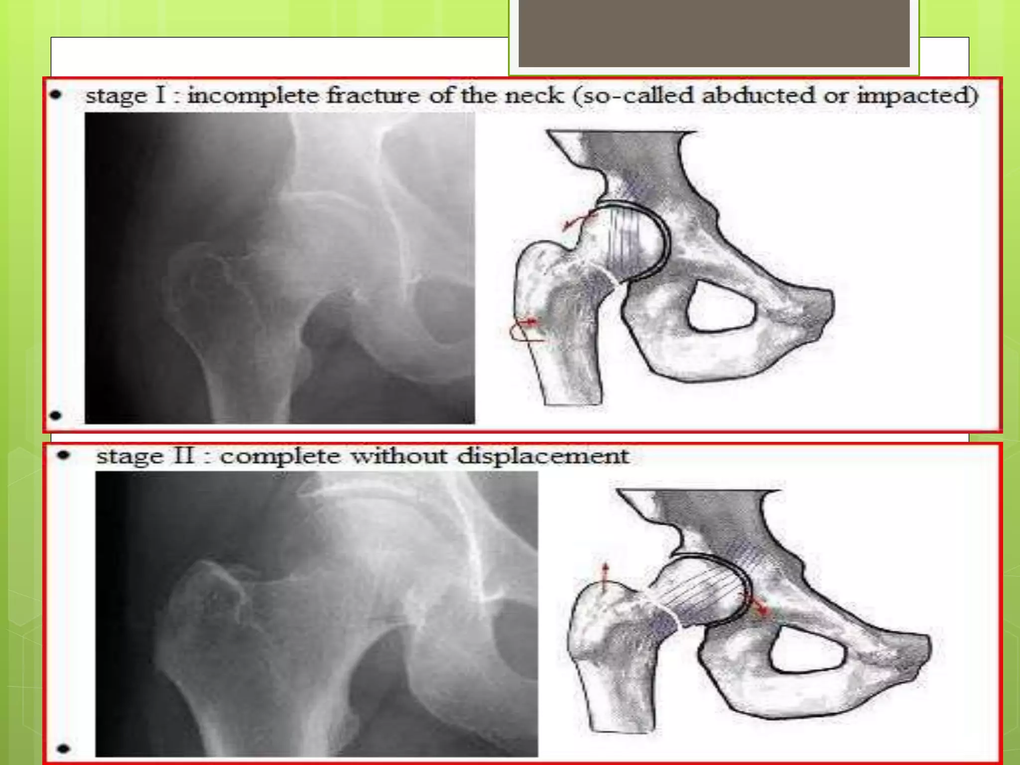 Nof fracture | PPTX