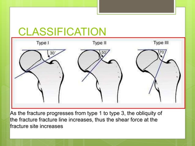 Nof fracture | PPTX