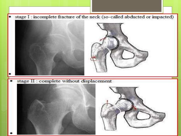 Nof fracture | PPTX
