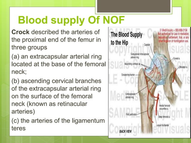 Nof Fracture