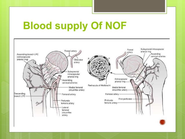 Nof fracture