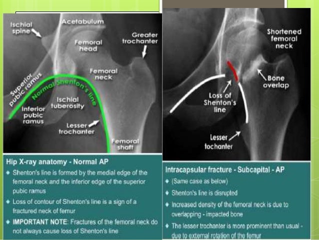 Nof fracture