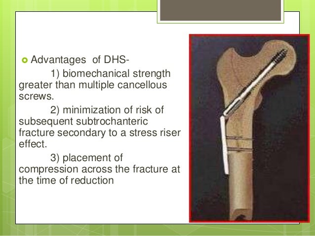 Nof Fracture
