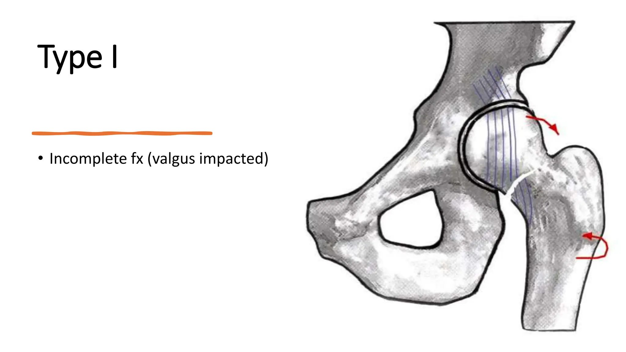 Neck of femur fracture. Power point presentation | PPTX
