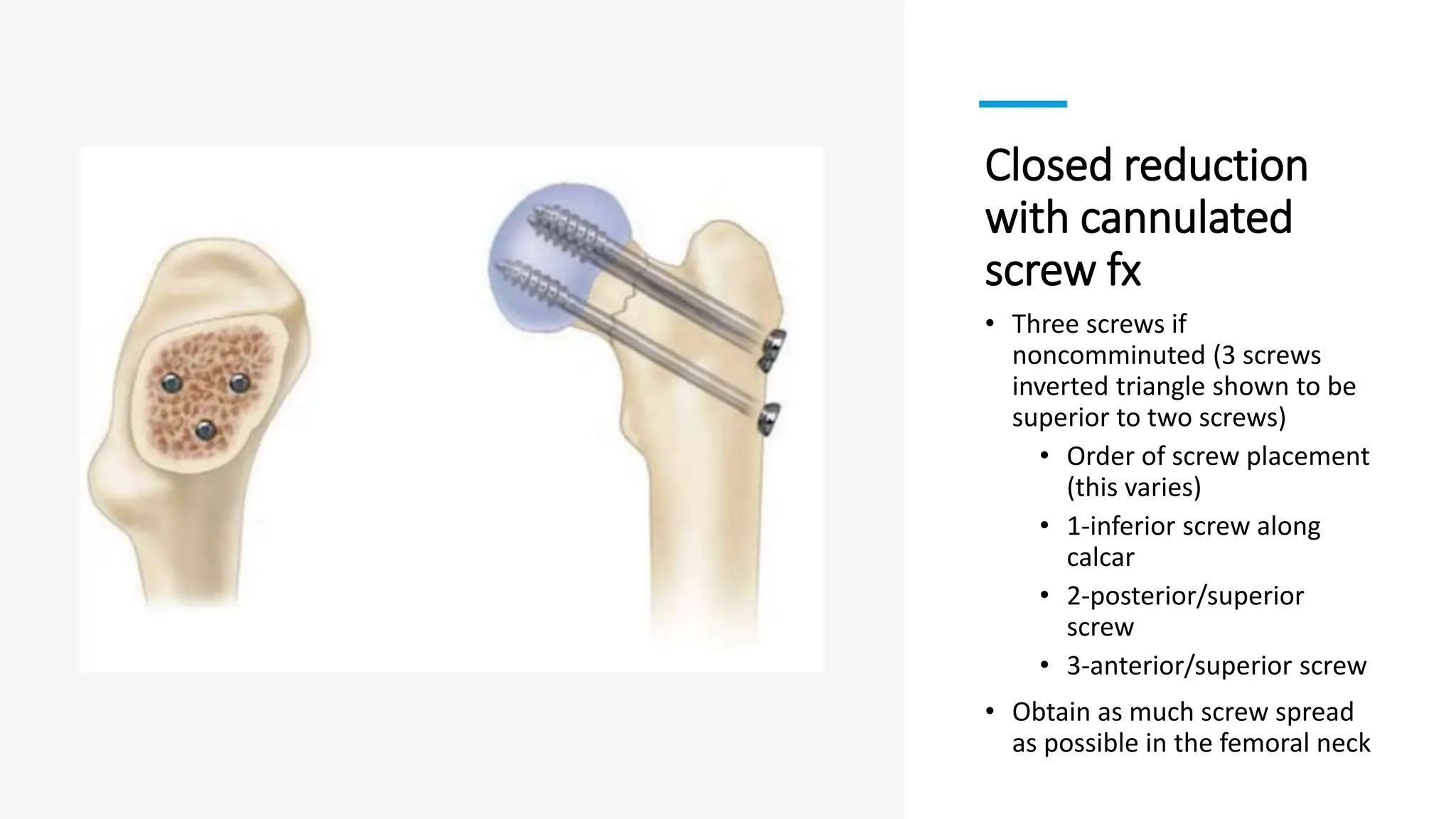 Neck of femur fracture. Power point presentation | PPTX