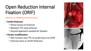 Neck of femur fracture. Power point presentation | PPTX