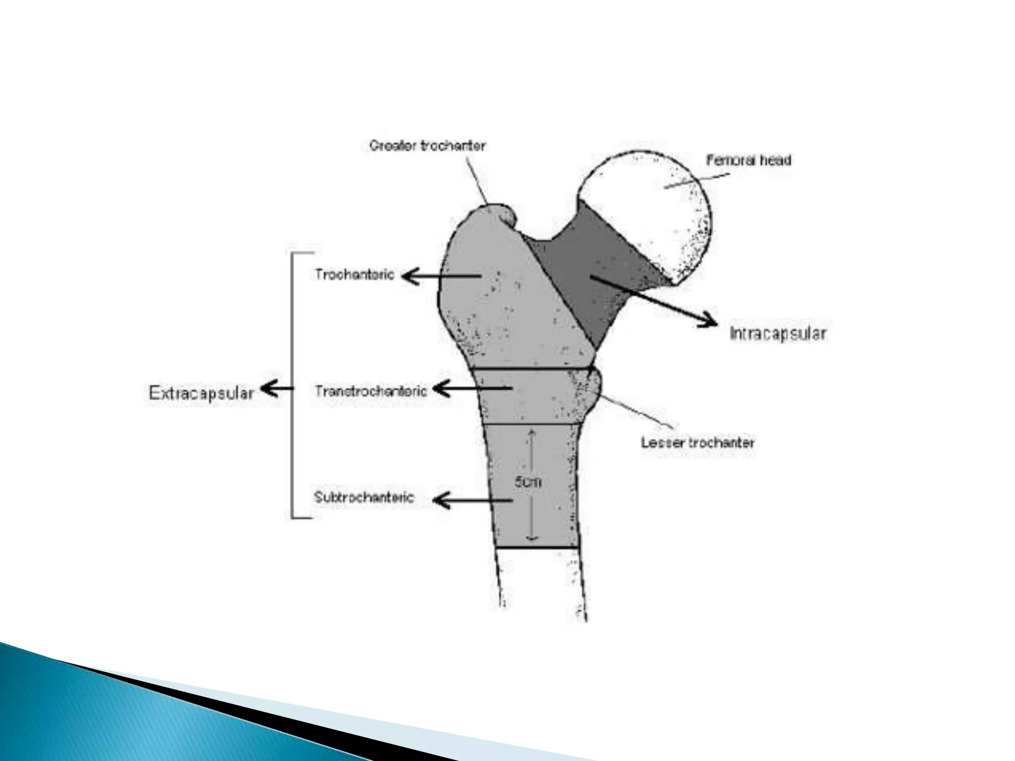 Proximal Femur Fractures with NOF & IT | PPTX