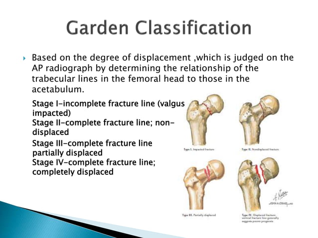 Proximal Femur Fractures with NOF & IT | PPT