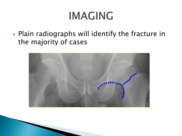Proximal Femur Fractures with NOF & IT | PPT
