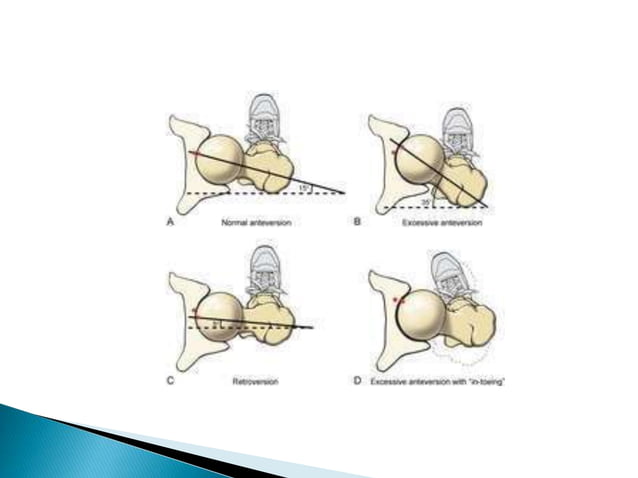 Proximal Femur Fractures with NOF & IT | PPT