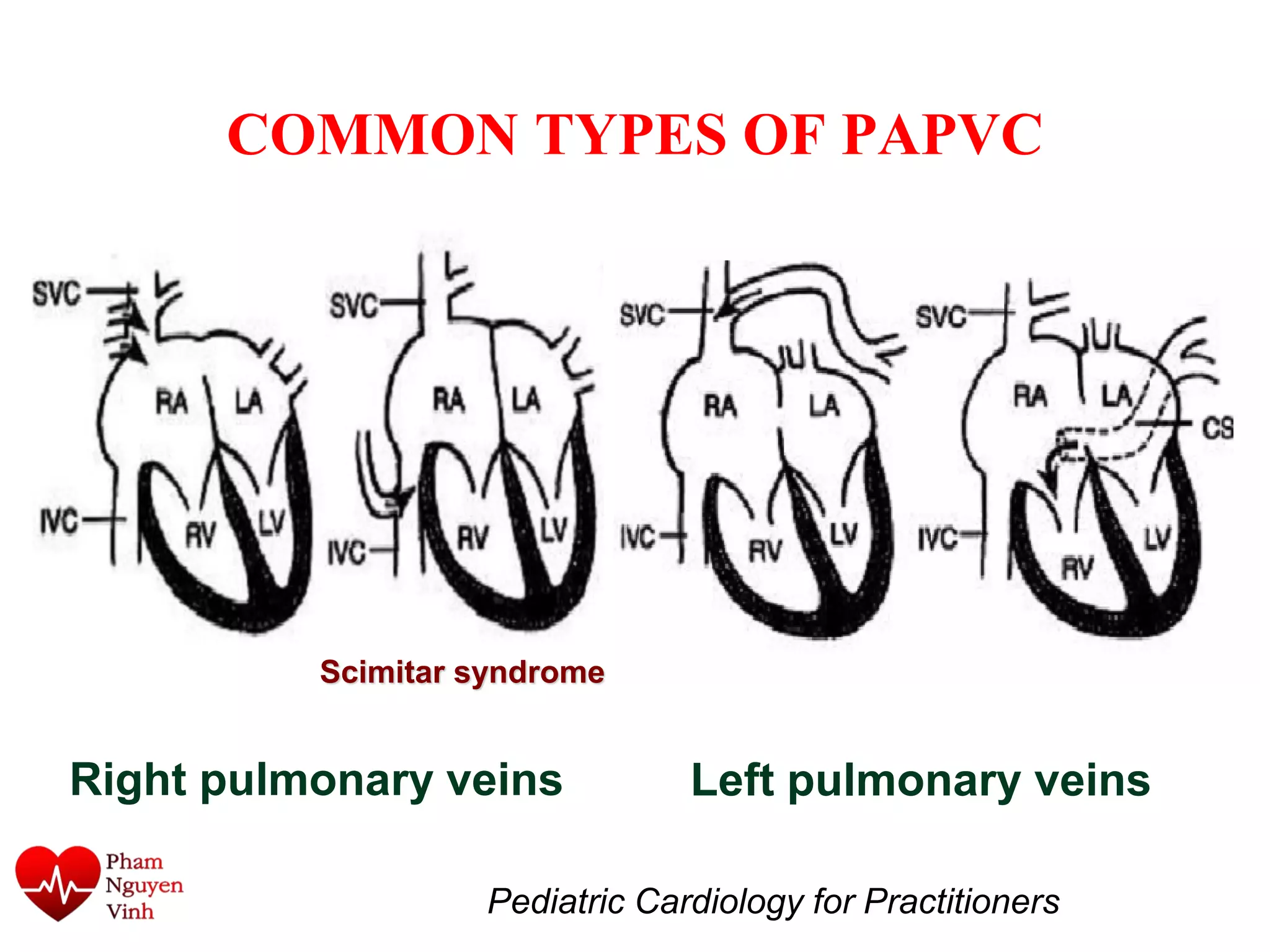 Noi lien-bat-thuong-tinh-mach-phoi-pham-nguyen-vinh | PDF