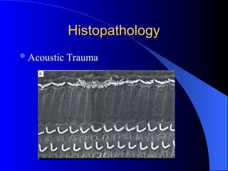 Noise Induced Hearing Loss management in detail | PPT