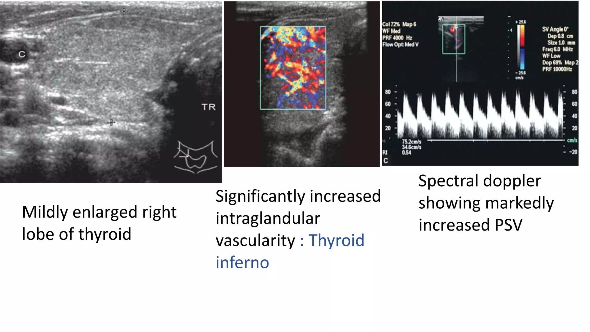 Thyroid Ultrasound and TIRADS | PPTX