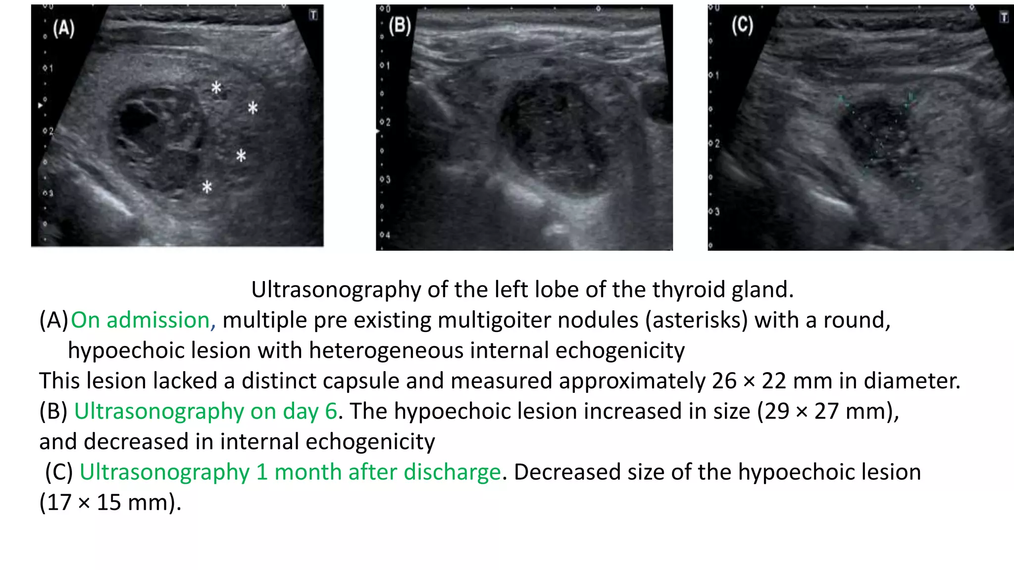 Thyroid Ultrasound and TIRADS | PPTX