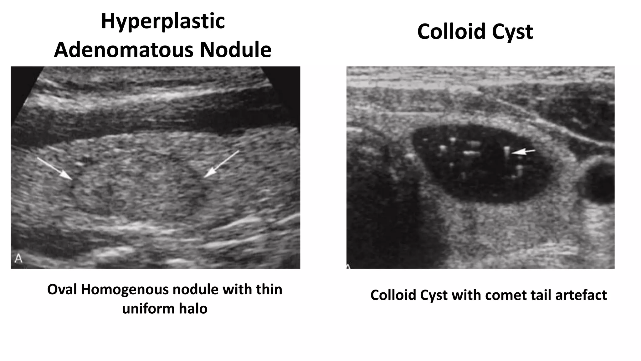 Thyroid Ultrasound and TIRADS | PPTX