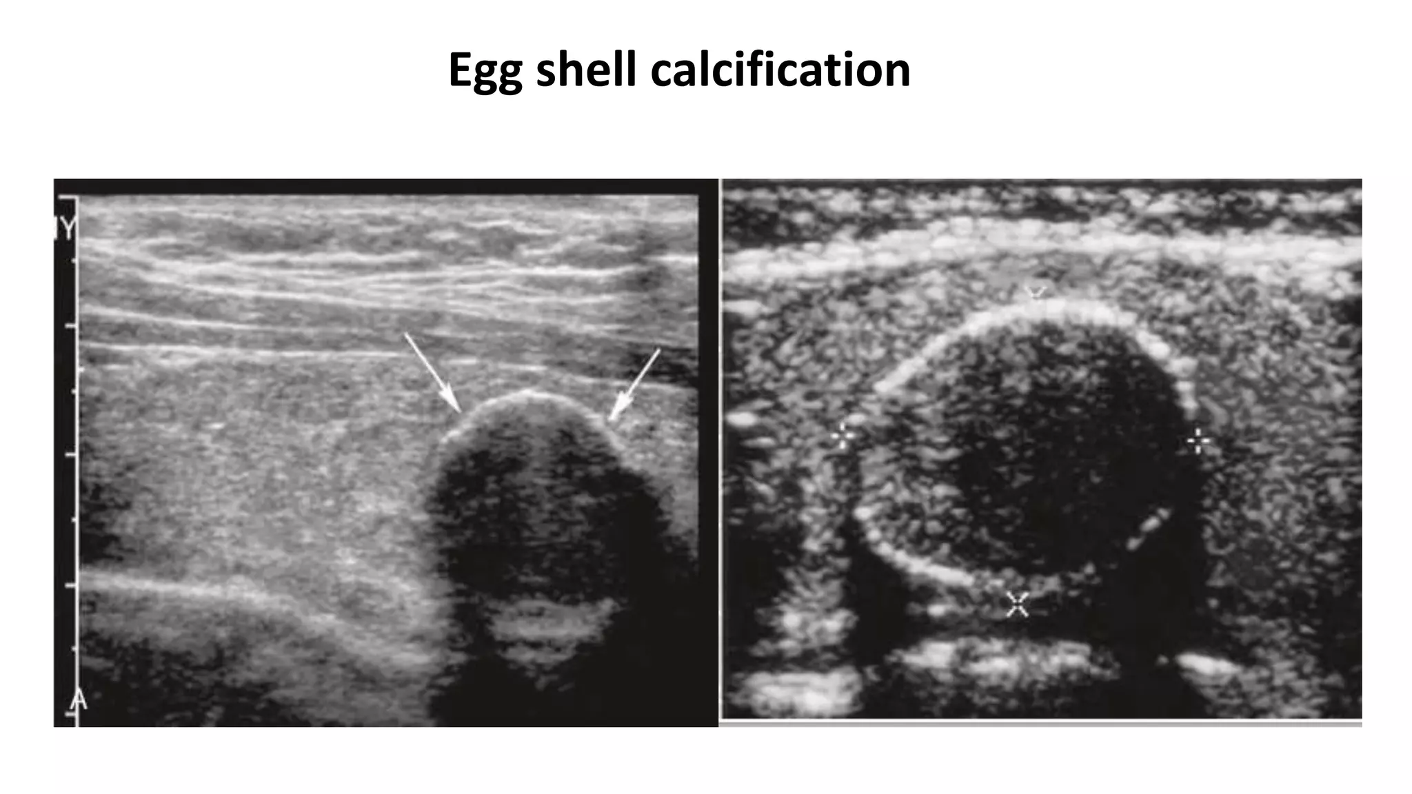 Thyroid Ultrasound and TIRADS | PPTX