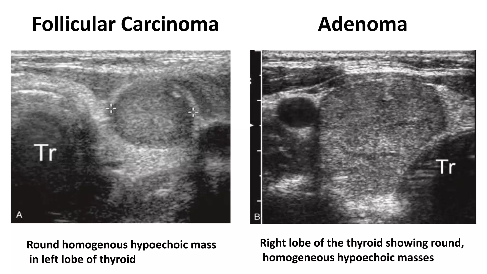 Thyroid Ultrasound and TIRADS | PPTX