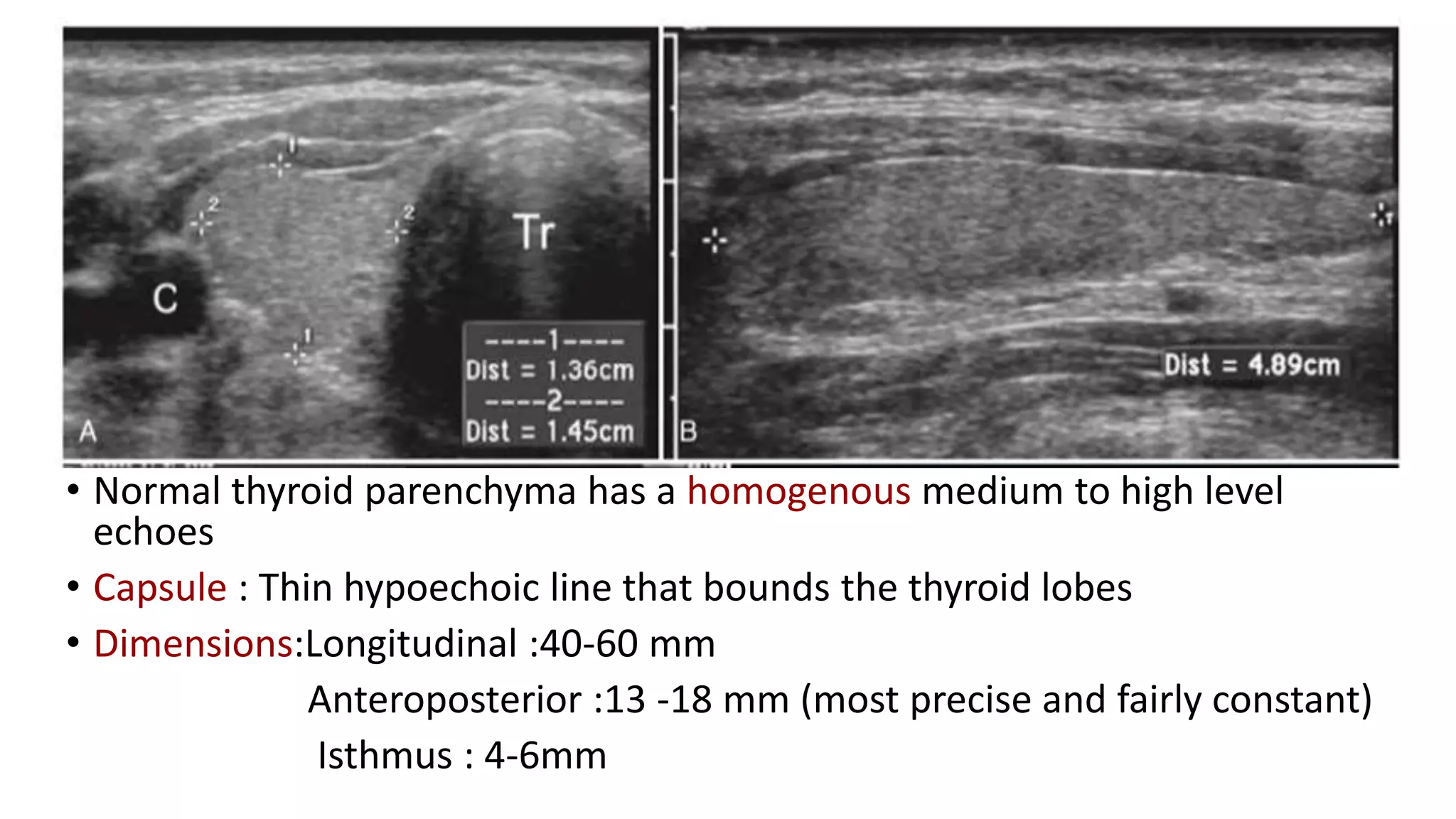Thyroid Ultrasound and TIRADS | PPTX