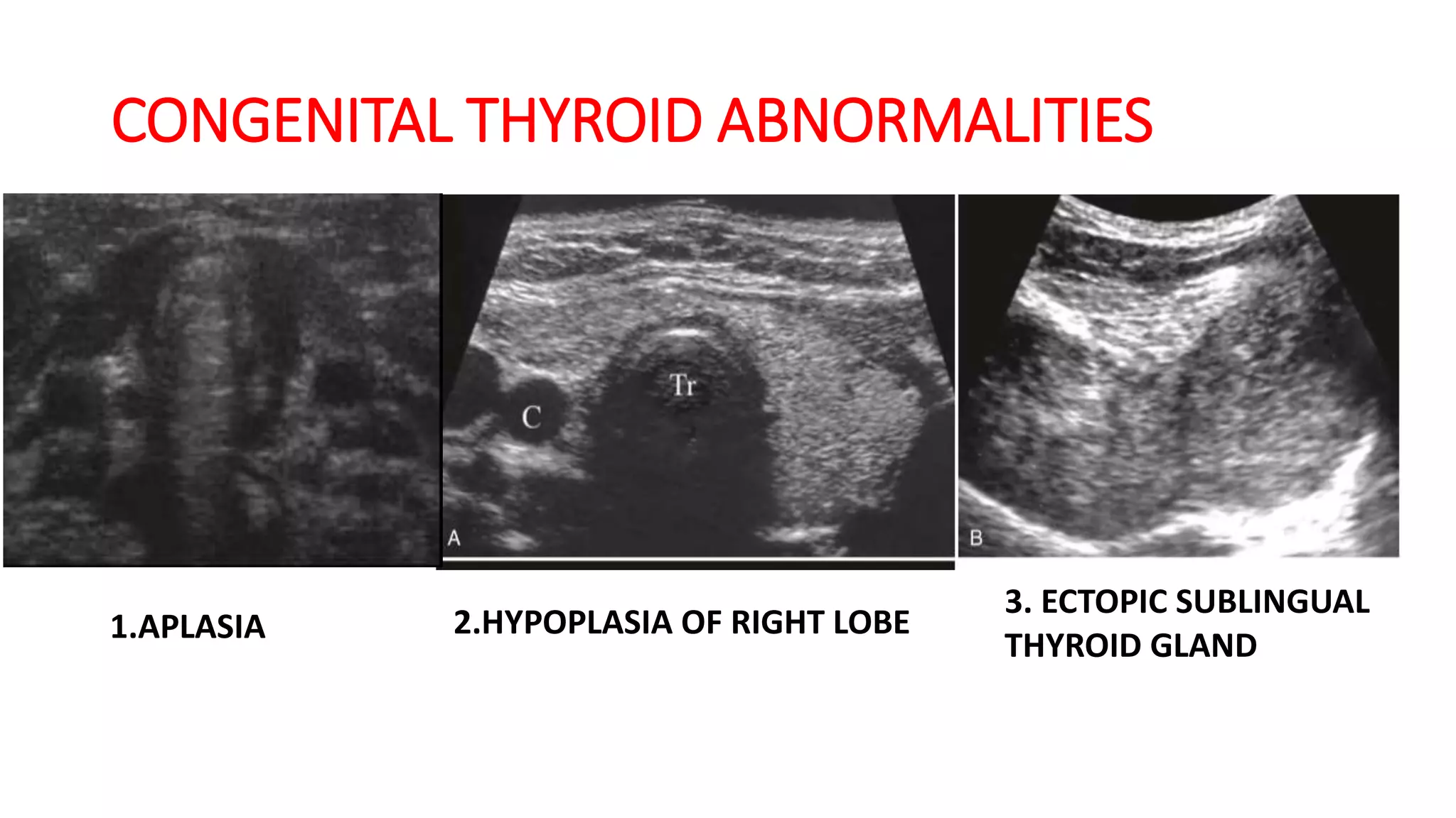 Thyroid Ultrasound and TIRADS | PPTX