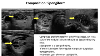 Thyroid Ultrasound and TIRADS | PPTX